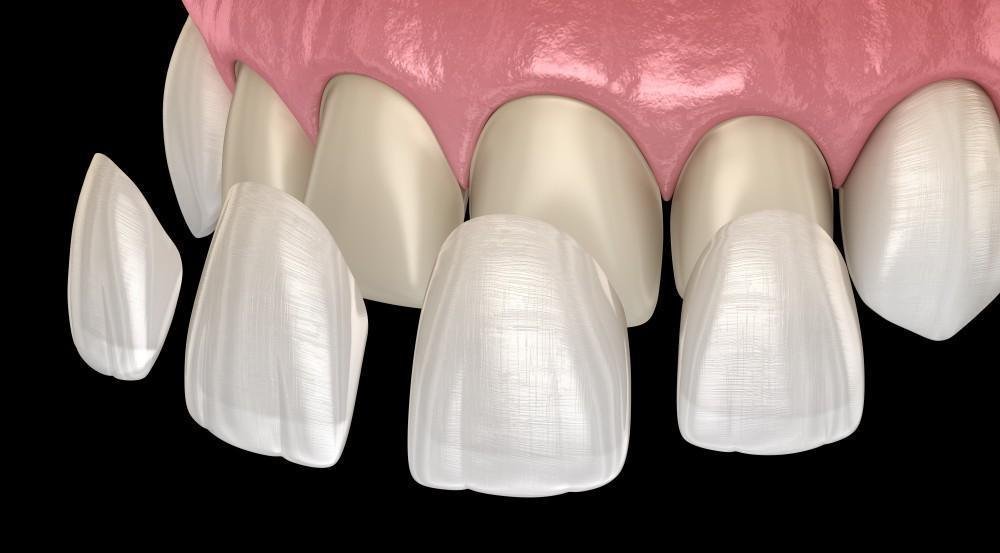 Veneers - implantsquare.com