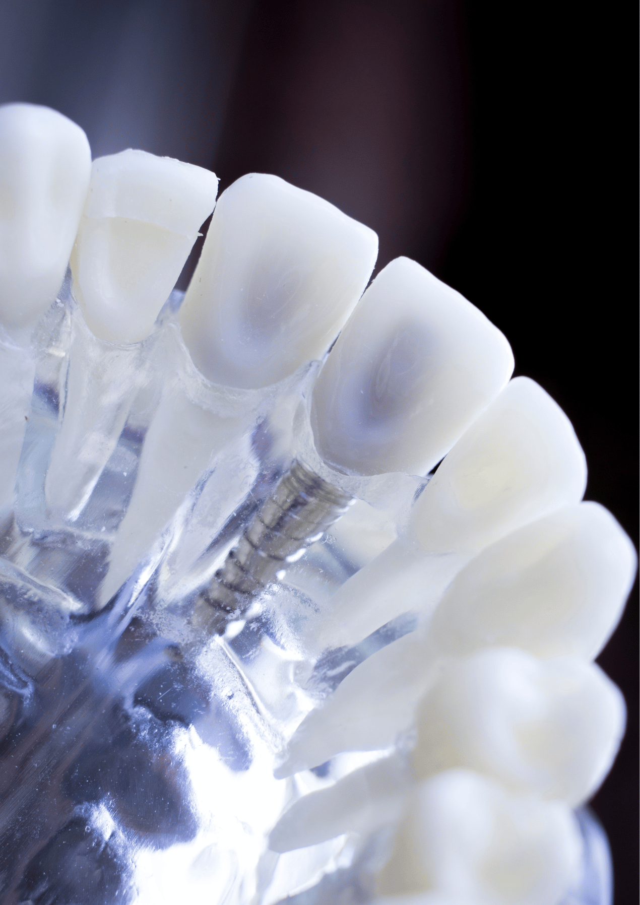 All-on-4 Implants - implantsquare.com